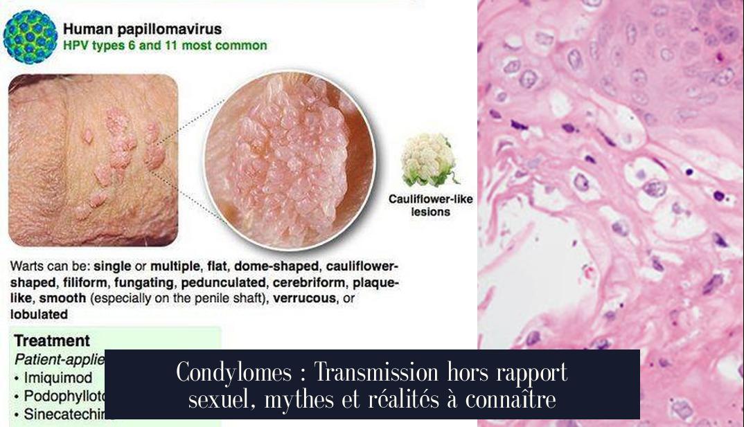 Condylomes : Transmission hors rapport sexuel, mythes et réalités à ...